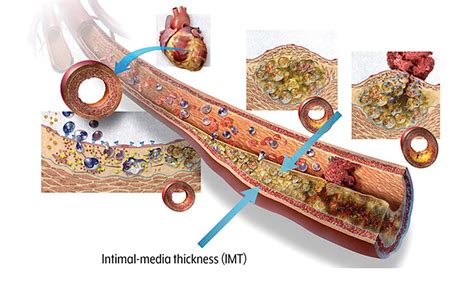 Clinical Basis For IMT Cypress Heart Health Early Detection