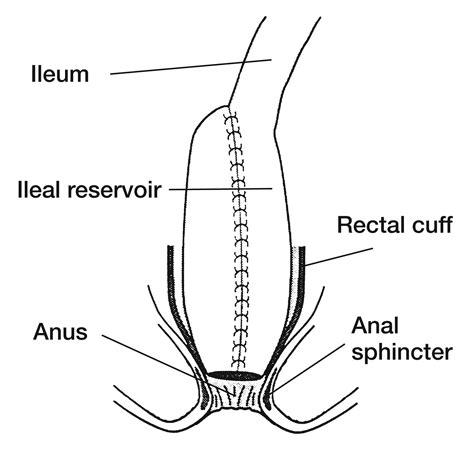 The Differences Between An Ileostomy And A J Pouch