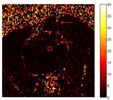 Figure 21 From Stochastic Data Assimilation Approaches For Magnetic Resonance Temperature