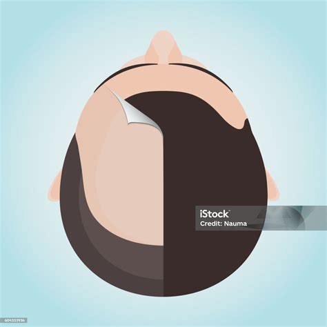 Pria Botak Dengan Setengah Unstuck Ilustrasi Stok Unduh Gambar Sekarang Rambut Manusia