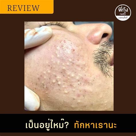 สิวอุดตั พี่กุ้งกดสิว มาดามกิ๊กกี้ สาขาสะพานสูง ซอยมิสทีน