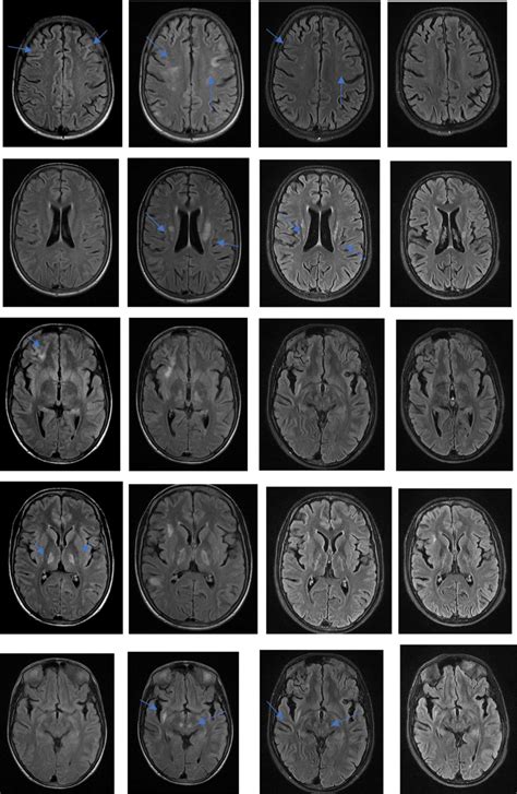 Long Survival After Progressive Multifocal Leukoencephalopathy In A Download Scientific Diagram