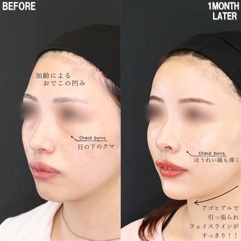 顔 に できる 脂肪 顔の脂肪吸引 経過 Mgsq