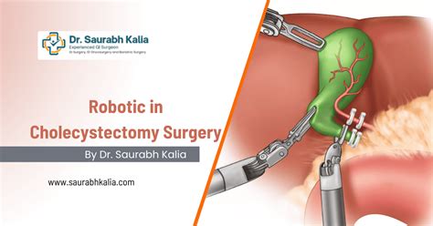 Robotic In Cholecystectomy Surgery By Dr Saurabh Kalia Dr Saurabh Kalia