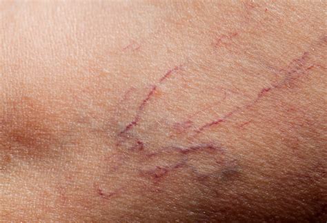 Reticular Veins Vs Telangiectasia Spider Veins Australia
