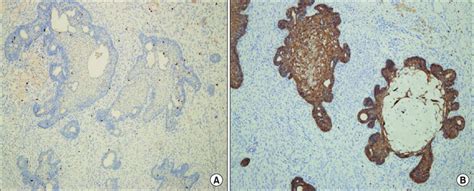 Immunohistochemical Stains Of The Tumor A Ki 67 Was Detected In Some
