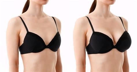 What To Expect After Breast Augmentation Surgery 303 470 3400