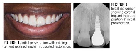 Cosmetic Considerations For The Single Anterior Implant Restoration