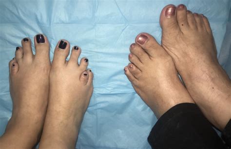 Brachymetatarsia A Classification For Surgical Treatment The Journal