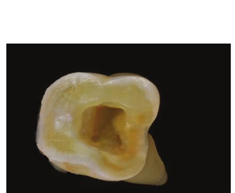 Pulpotomy And Access Cavity For Primary Molar
