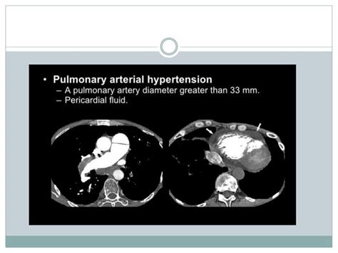 Pulmonary Embolism Radiology Pptx