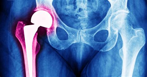 Hip Replacement Infection Causes Symptoms And Treatment
