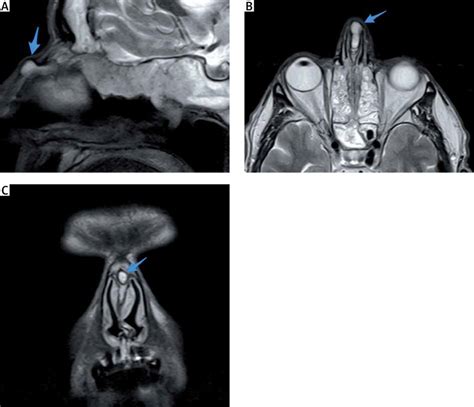Combined Minimally Invasive Surgical Management Of A Nasal Dermoid