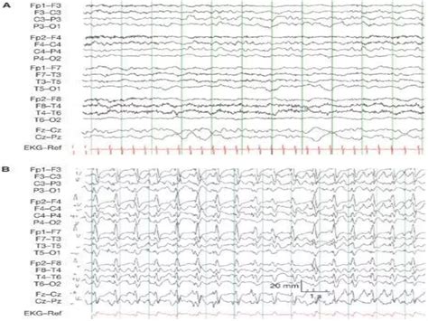 Non Convulsive Status Epilepticus Clinical Features Diagnosis Pptx