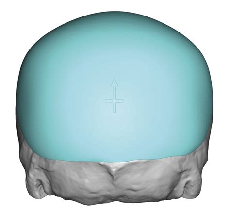 Custom Back Of The Head Skull Implant For Adult Male Brachycephaly Explore Plastic Surgery