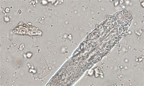 Surprises On Microscopic Fecal Examination Image Gallery