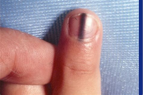 Big Toenail Has Vertical Light Brown Line Melanoma Scary Symptoms