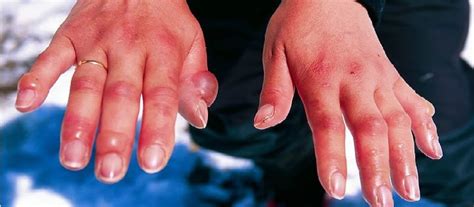 Diagnosis And Treatment Of Buergers Disease Vinmec