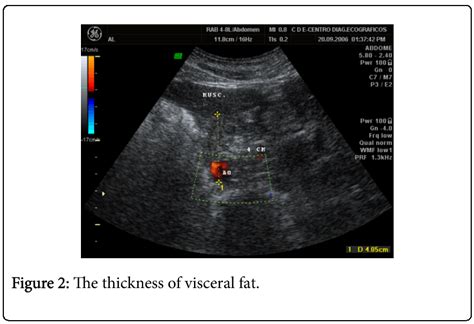 The Ultrasonography Image Of Abdominal Fat