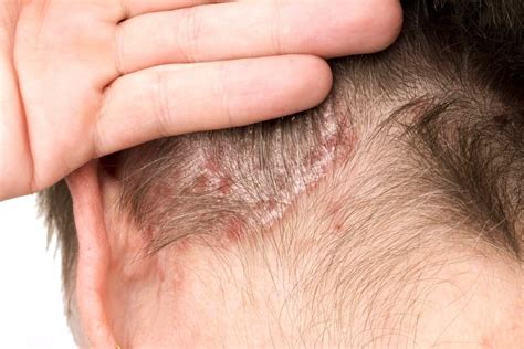 Psoriasis Kulit Kepala Inilah Penyebab Dan Pengobatannya