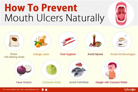 How To Fix Mouth Ulcers Canker Sore Aphthous Ulcer What It Is