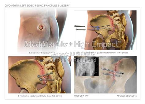 Pelvic Fracture Surgery Medivisuals High Impact