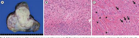 [pdf] anti n methyl d aspartate receptor nmdar encephalitis
