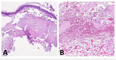 Hematoxylin And Eosin Staining Showing Eosinophilic Material Within The Download Scientific