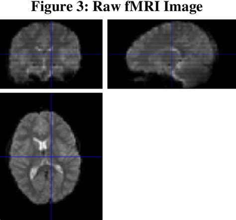 Figure 1 From Classification Of Autism Spectrum Disorder Using Resting State Functional Magnetic