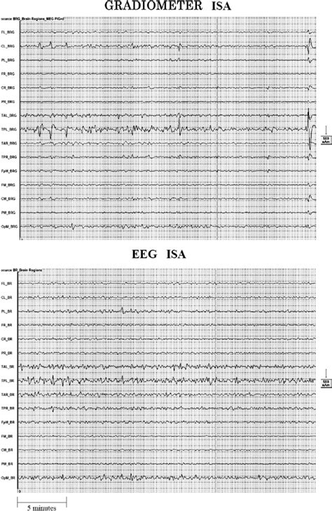 Magnetoencephalographic Meg And Eeg Infraslow Activity Isa Of Download Scientific Diagram