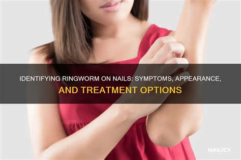 Identifying Ringworm On Nails Symptoms Appearance And Treatment