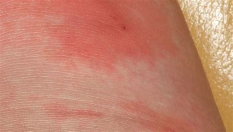 Superdrug Health Clinic Types Of Bacterial Skin Infections
