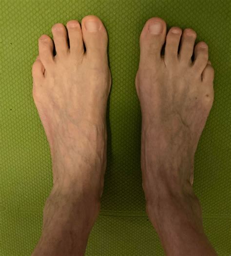 Foot Swelling Rlupus