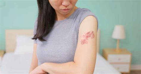 Everything You Need To Know About Shingles