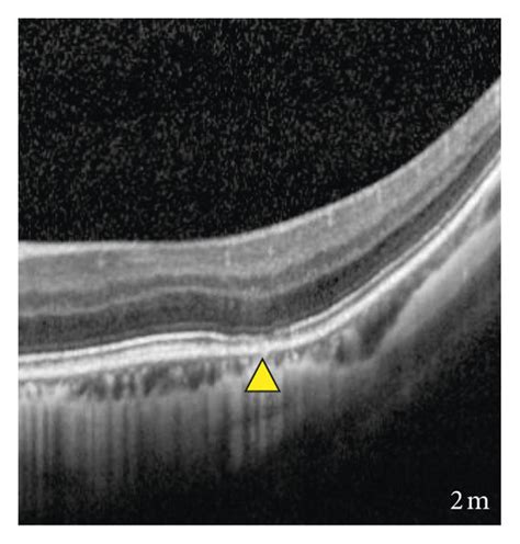 Multimodal Imaging Findings In A 49 Year Old Highly Myopic Man With Download Scientific Diagram