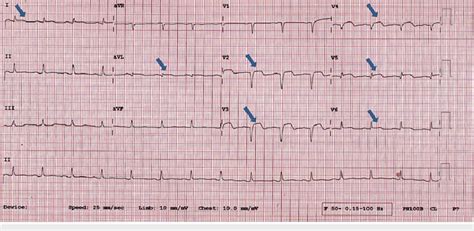 St Elevations Seen On Ecg In Leads I Avl V2 V6 Avr Augmented Vector Download Scientific