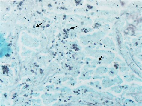 🔬 Histopathology Spotlight Fungal Infection Cryptococcus Dr Kashish Sharma 🔬 Histopathology Spotlight Fungal Infection Cryptococcus Dr Kashish Sharma