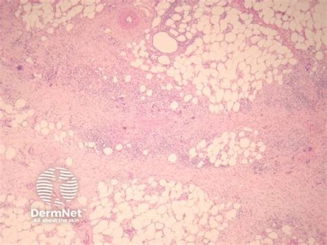 Erythema Nodosum Pathology