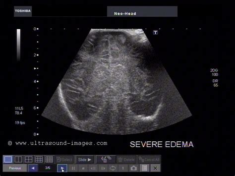 Cochinblogs Cerebral Edema In Neonates
