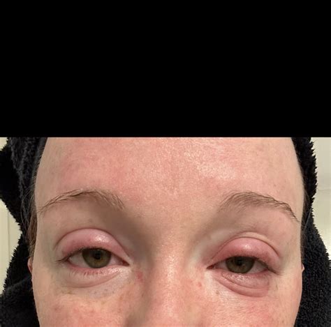 Pataday Wildfires Stress Tw Eye Swelling Rmcas