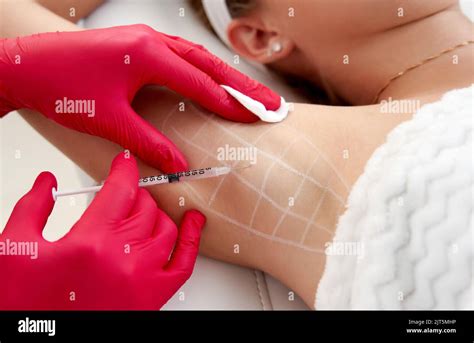 Doctor Makes Injections Of Botulinum Toxin In The Underarm Area Against