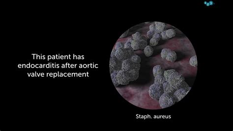 60 Seconds Of Echo Teaching Aortic Annular Fistula And Abscess Here Is The Answer To My Last