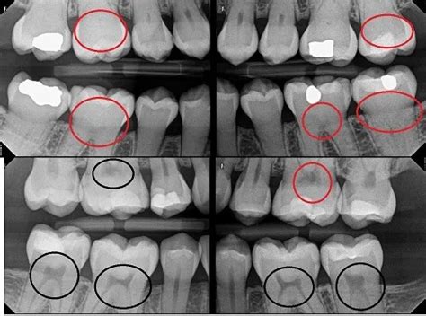 Dental Pulp Calcification All The Causes Bauer Smiles