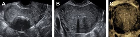 Ultrasound Assessment Of The Intrauterine Device Obstetrics And
