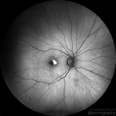 Acquired Vitelliform Lesion Retinography