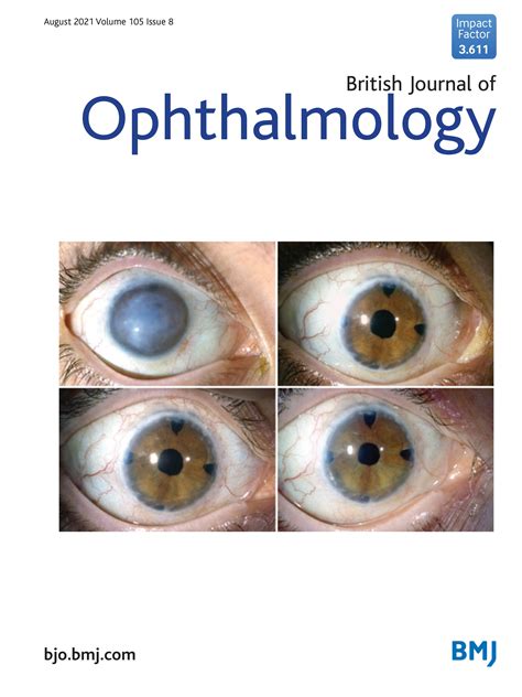 Focal Choroidal Excavation Review Of Literature British Journal Of Ophthalmology