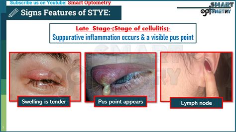 External Hordeolum Or Stye Everything You Need To Know Smart Optometry