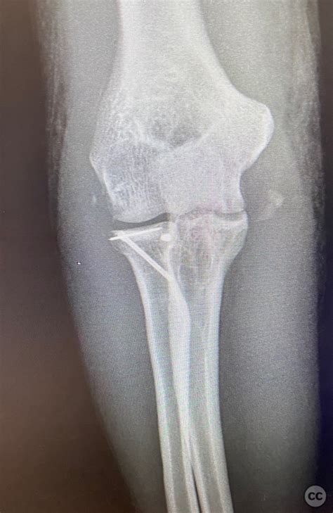 Radial Head Fracture With Medial And Anterior Displacement