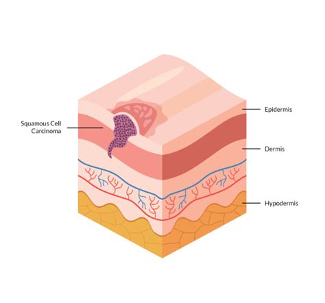 Dr Becker Skin Cancer Care Squamous Cell Carcinoma Care Near Black Diamond