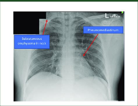 Subcutaneous Emphysema